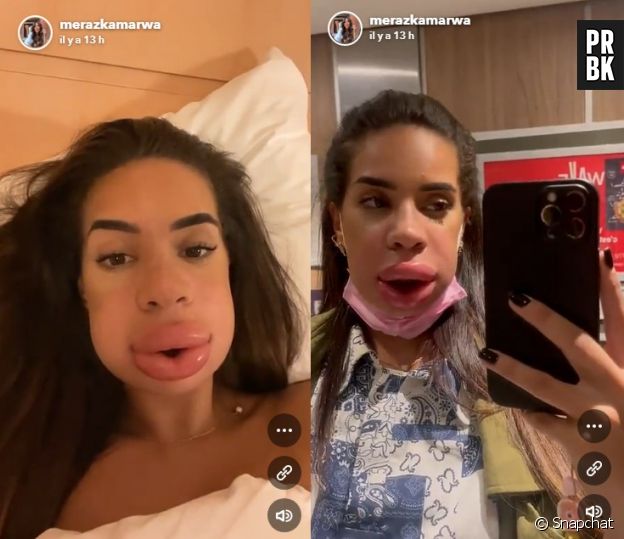 Marwa (Les Cinquante) défigurée après une injection, le résultat choc ...